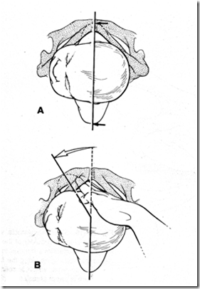 INFORMASI REPRODUKSI: DISTOSIA BAHU